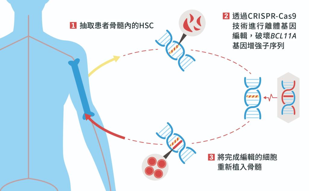 醫學革命之門開啟！展望首例獲准臨床應用的基因編輯療法Casgevy - 科學月刊Science Monthly
